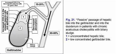 Chronic Acalculous Cholecystitis With Biliary Sludge