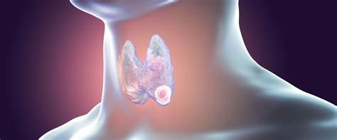 Understanding The 2022 Who Thyroid Cancer Classification