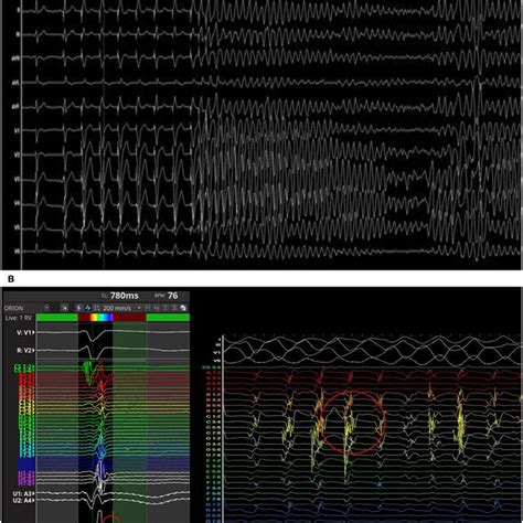 Polymorphic Ventricular Tachycardia Induced By Programmed Ventricular