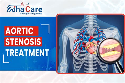 Top 5 Advanced Aortic Stenosis Treatment Surgical Vs Non Surgical