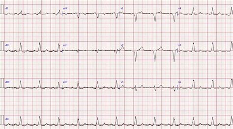 Ecgrecover A Deep Learning Approach For Electrocardiogram Signal Completion Ai Research Paper