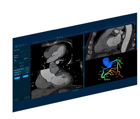 Deepvessel Ct Ffr Analysis Keya Medical Keyamedical