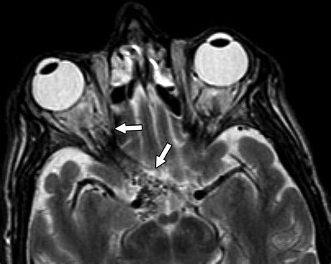 Orbital Lesions Differentiating Vascular And Nonvascular Etiologic
