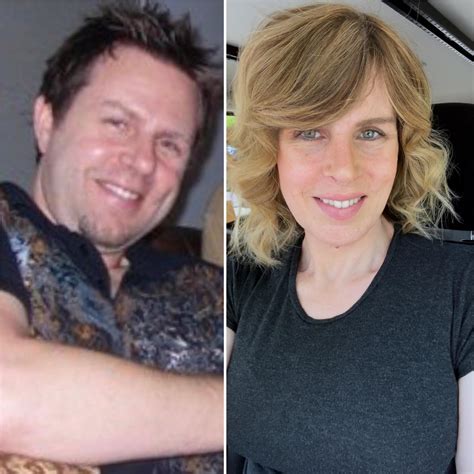 L Vs R Six Years HRT Plus FFS R Transtimelines