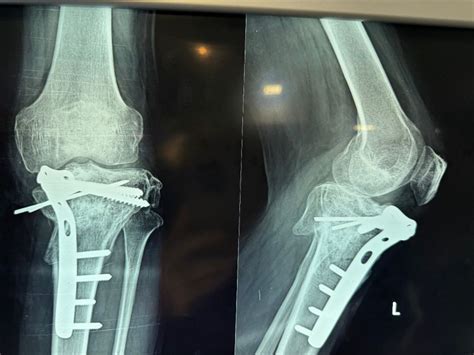 39 Year Old Rta Badly Fixed Proximal Tibia Fracture 3 Years Ago Followed By The Removal Of The