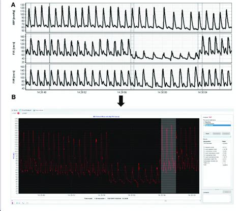 Transient Hyperaemic Response Ratio Thrr A Icm Raw Data Showing A