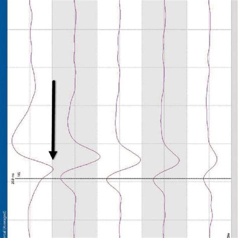 A Left Median Nerve Somatosensory Phase Reversal Recorded Over The