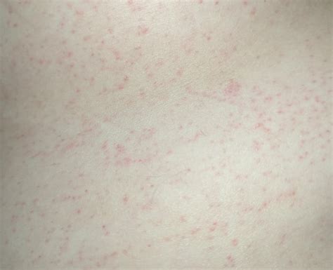Heat Rash Over Entire Body R Hyperhidrosis