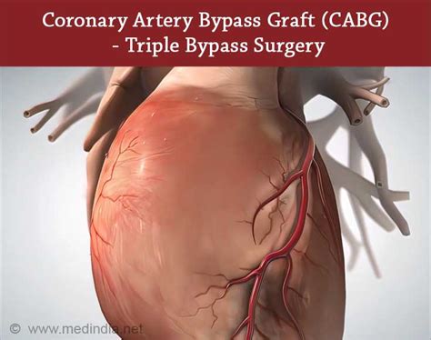 What Is Triple Bypass Surgery At Glenn Barbee Blog