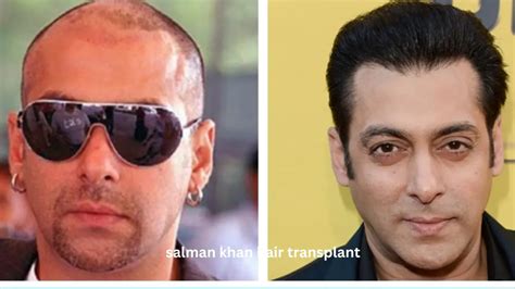 Salman Khan Hair Transplant Dr Hanan Dermatology Speciality Clinic