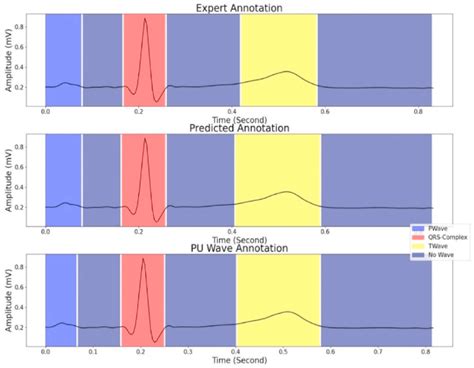 The Sample Of Classification Process For P Wave Qrs Complex T Wave