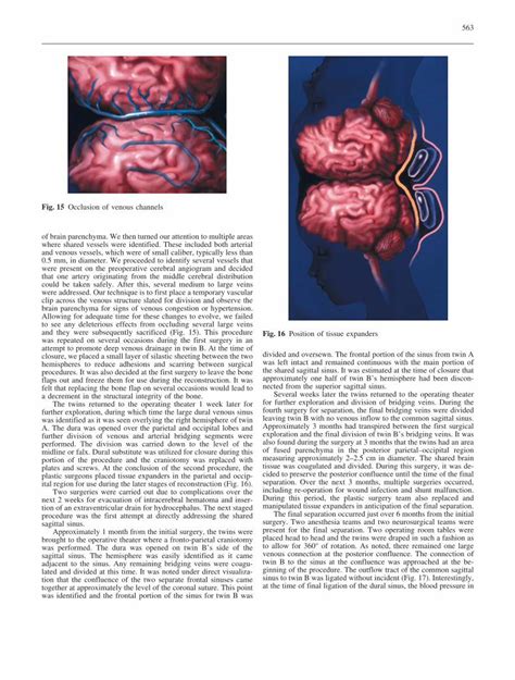 Pdf Craniopagus Twins Embryology Classification Surgical Anatomy