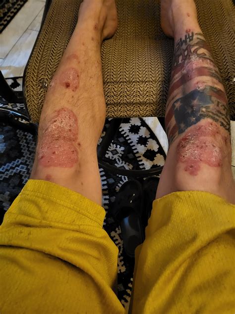 Psoriasis And Sex Rpsoriasis