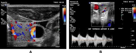 Color Doppler Hemodynamic Parameters Of The Left Inferior Thyroid