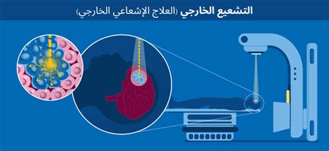 ما العلاج الإشعاعي؟ Iaea