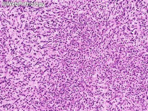 Myxoid Liposarcoma Additional Images
