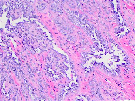 Pathology Outlines Angiosarcoma