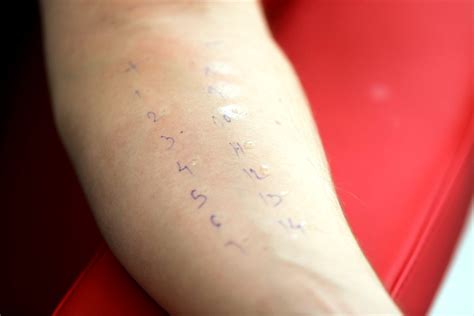 Dr Jasmina Nurkić Osobe Sklone Alergijama Su One Koje Pate I Od Zagađenja Zraka Tuzlanskiba