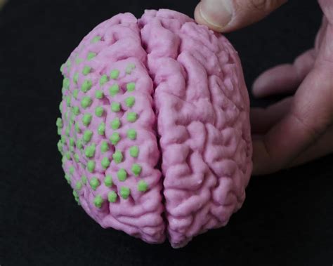 3d Printing For Intracranial Eeg Electrodes Localization Individualized Surgical Planning For