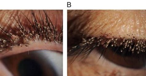 속눈썹에 기생충이 검은 점처럼 보이는 벌레가 ‘꿈틀꿈틀