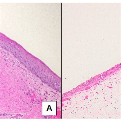 Connective Tissue Fibrosis As Well As Epithelial Squamous Metaplasia