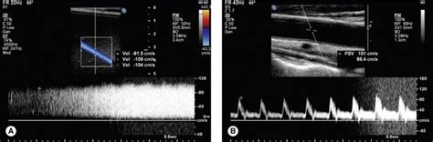 Factors That Influence The Doppler Spectrum Radiology Key