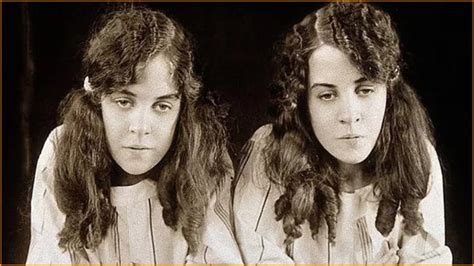 Conjoined Hilton Twins