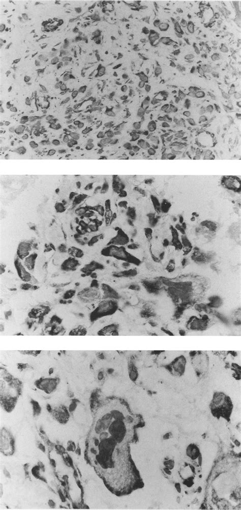 Vimentin Labeling In Endothelial And Tumor Cells X 200 Download