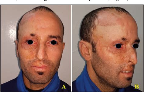 Figure 1 From Aesthetic Reconstruction Of Post Burn Eyebrow Alopecia
