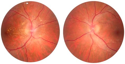 Normal Optic Nerve Vs Papilledema