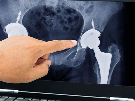 Traumatólogo Experto En Cadera En Valencia Corbi Clinic