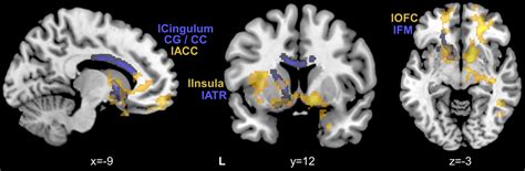 Disrupted Salience Network Functional Connectivity And White Matter Microstructure In Persons At