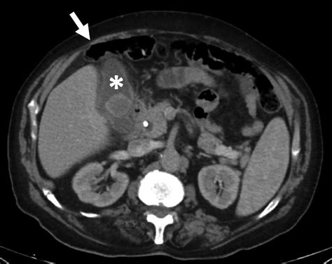 Transhepatic Cholecystostomy For Percutaneous Biliary Drainage
