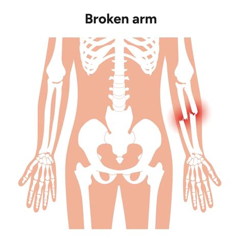 Premium Vector Broken Arm Ulna And Radius