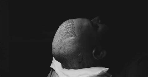 Best Tips To Prevent Infection After A Hair Transplant