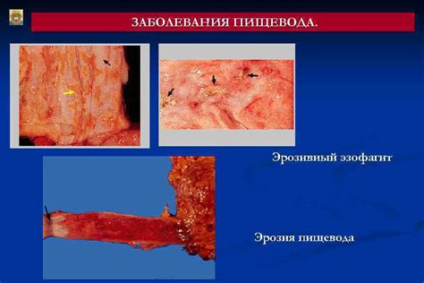 БОЛЕЗНИ ЖЕЛУДОЧНО-КИШЕЧНОГО ТРАКТА ЗАБОЛЕВАНИЯ ПИЩЕВОДА Эрозивный эзофагит