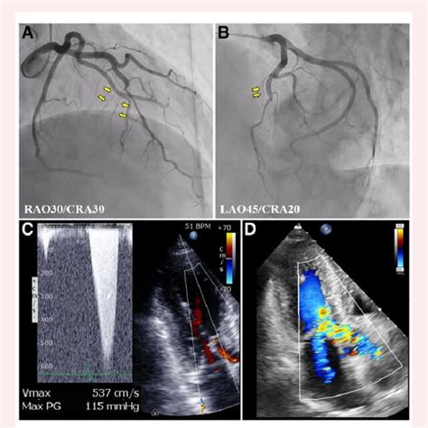 Pre Operative Evaluation Of The Left Ventricular Outflow Tract