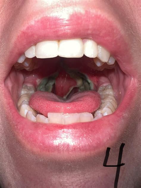 Tonsillectomy Recovery With Pictures Rtonsilstones