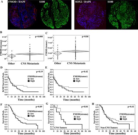 Analysis Of Fmod Expression In Melanoma Patient Samples A Download Scientific Diagram