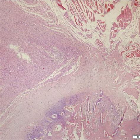 Rheumatoid Nodule Nodular Lesion Infiltrating The Striated Muscle Download Scientific Diagram