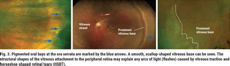 Navigating The Retinal Periphery