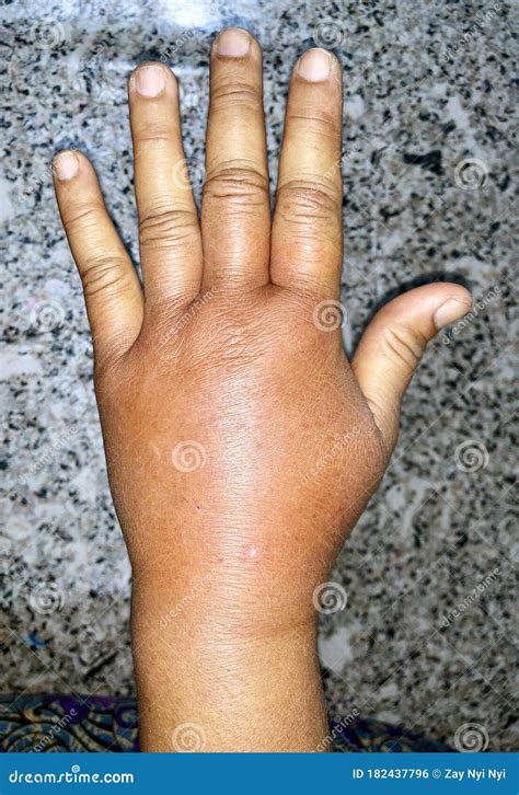 Painful And Swollen Right Hand In Adult Female Burmese Patient