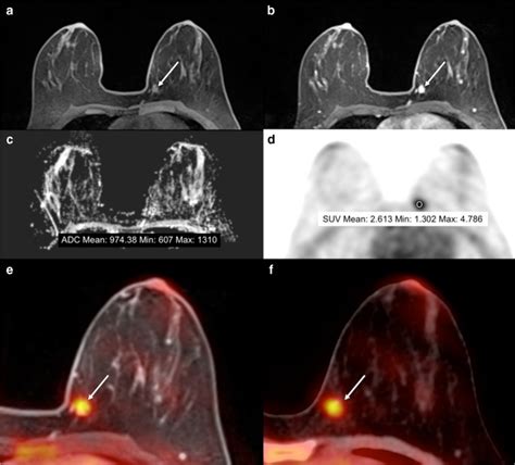 A Multiparametric 18f Fdg Petmri Diagnostic Model Including Imaging