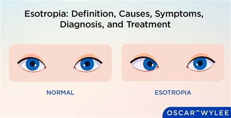 Esotropia Definition Causes Symptoms Diagnosis And Treatment