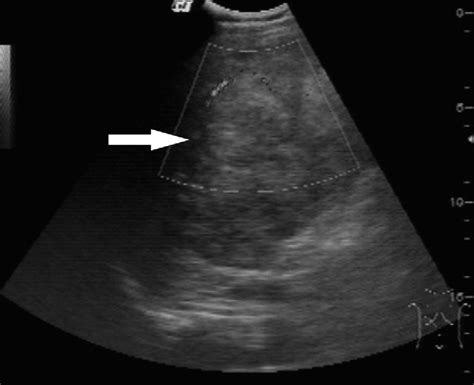 Abdominal Ultrasonography Shows A Mass Of Mixed Echogenecity In The Download Scientific Diagram