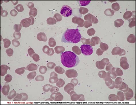 Chronic Myeloid Leukaemia Cml Bcr Abl1 Positive Blast Phase