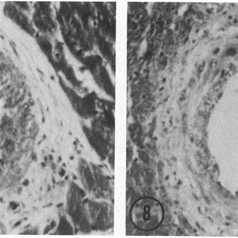 Extention Of Parvus Tardus Waveform To Abdominal Aorta Download