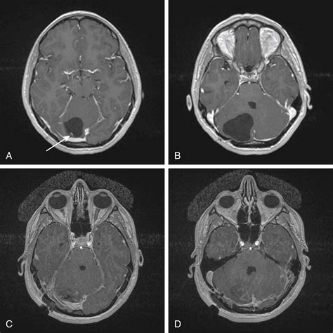 Cerebellar Tumors In Adults Clinical Tree