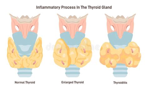 Thyroiditis Thyroid Inflammation Thyroid Gland Produces Abnormal Stock Vector Illustration