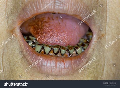 Black Calculus Teeth